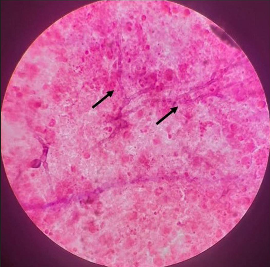 Subcutaneous phaeohyphomycoses caused by Exophiala xenobiotica in an ...