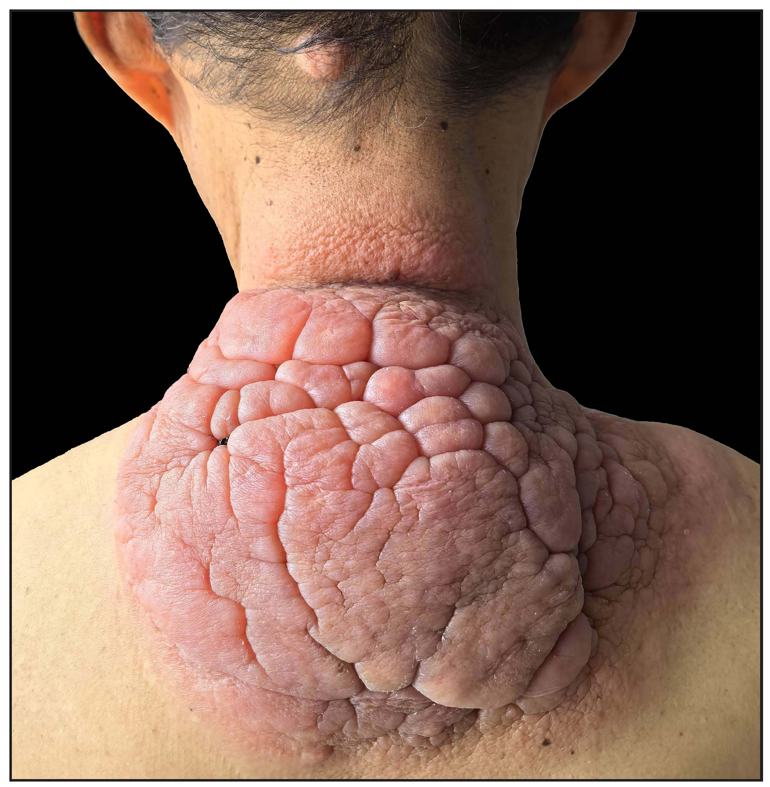 Giant cutaneous metastasis of gastric signet ring cell carcinoma ...